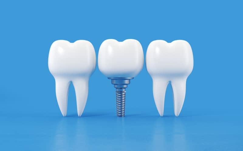 Are Dental Implants As Strong As Real Teeth?